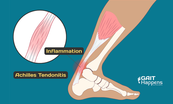 Know the Symptoms of Achilles Tendonitis / Tendinopathy